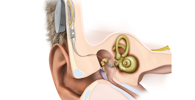 Vibrant Soundbridge: Die Brücke zum besseren Hören