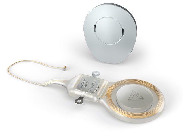VIBRANT SOUNDBRIDGE Middle Ear Implant System | MED-EL Middle Ear Implants